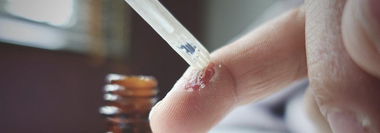 5 Best Wart Removers - Oct. 2025 - BestReviews